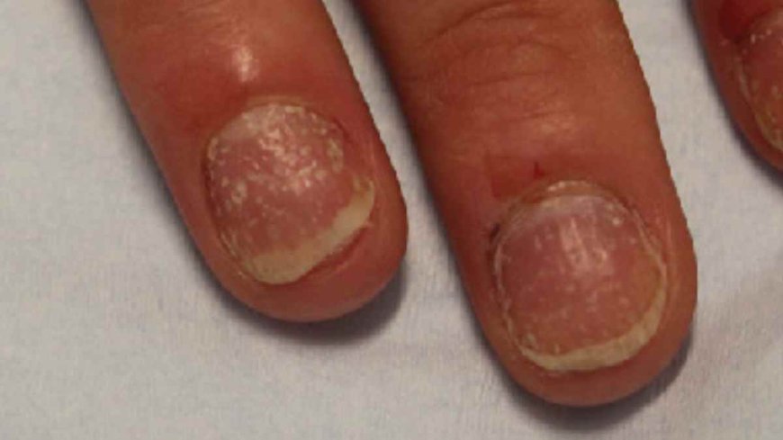 What Do Your Nails Say About Your Health? 7 Surprising Indicators ...